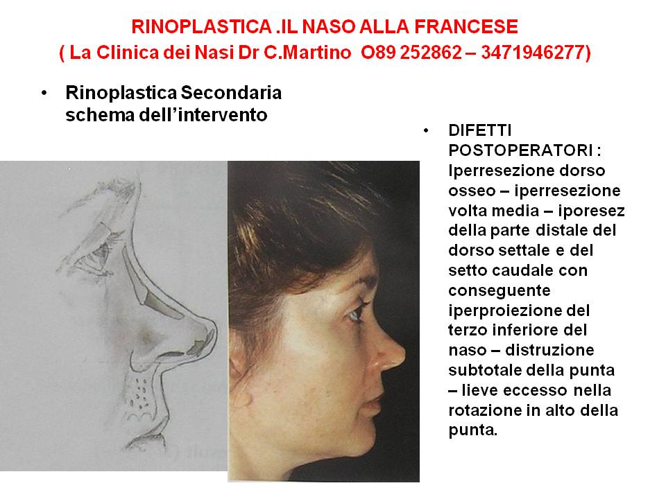 RINOPLASTICA: IL NASO ALLA FRANCESE