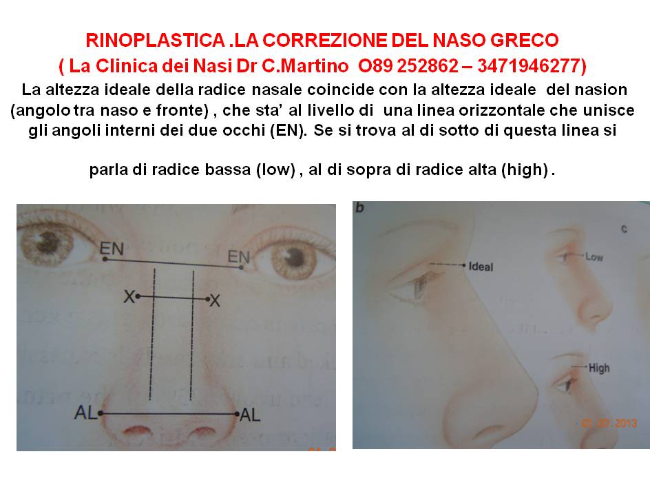 RINOPLASTICA : LA CORREZIONE DEL NASO GRECO