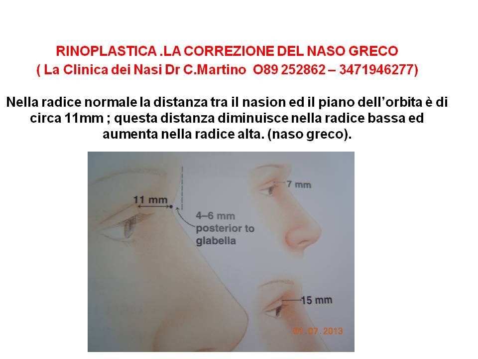 RINOPLASTICA : LA CORREZIONE DEL NASO GRECO