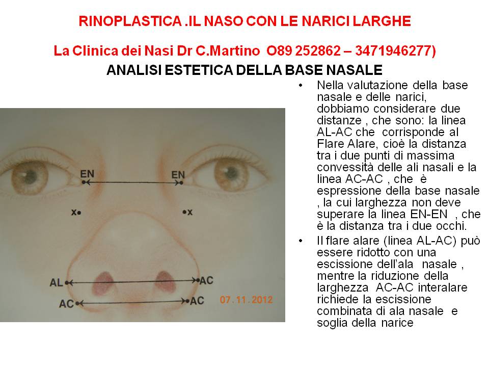 RINOPLASTICA: IL NASO CON LE NARICI LARGHE
