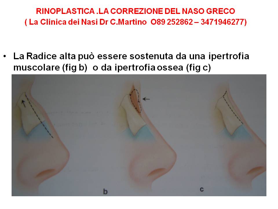 RINOPLASTICA : LA CORREZIONE DEL NASO GRECO