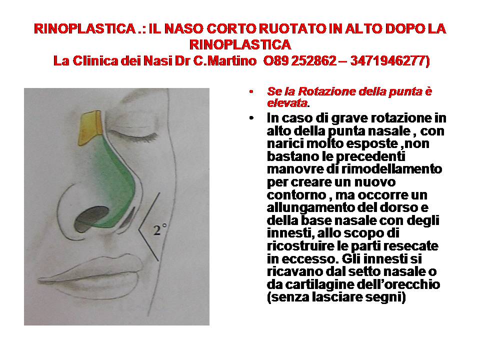 RINOPLASTICA : IL NASO CORTO RUOTATO IN ALTO DOPO LA RINOPLASTICA