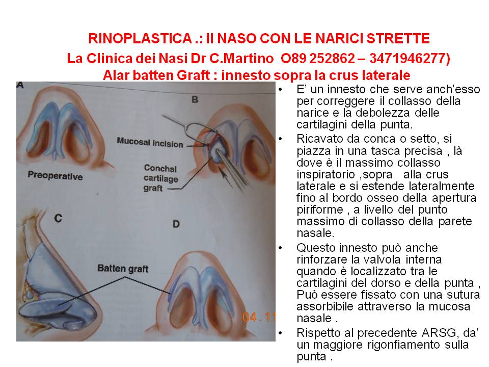 RINOPLASTICA : IL NASO CON LE NARICI STRETTE