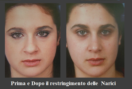 RINOPLASTICA (LE NARICI E LA LORO FORMA)