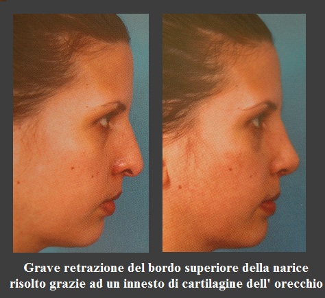 RINOPLASTICA (LE NARICI E LA LORO FORMA)