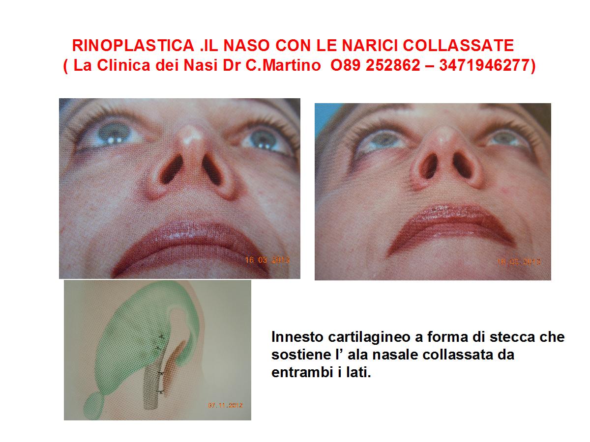 RINOPLASTICA : LE NARICI COLLASSATE